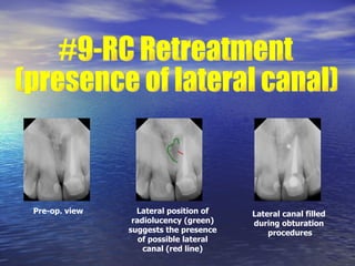 Endodontic Clinical Cases | PPT
