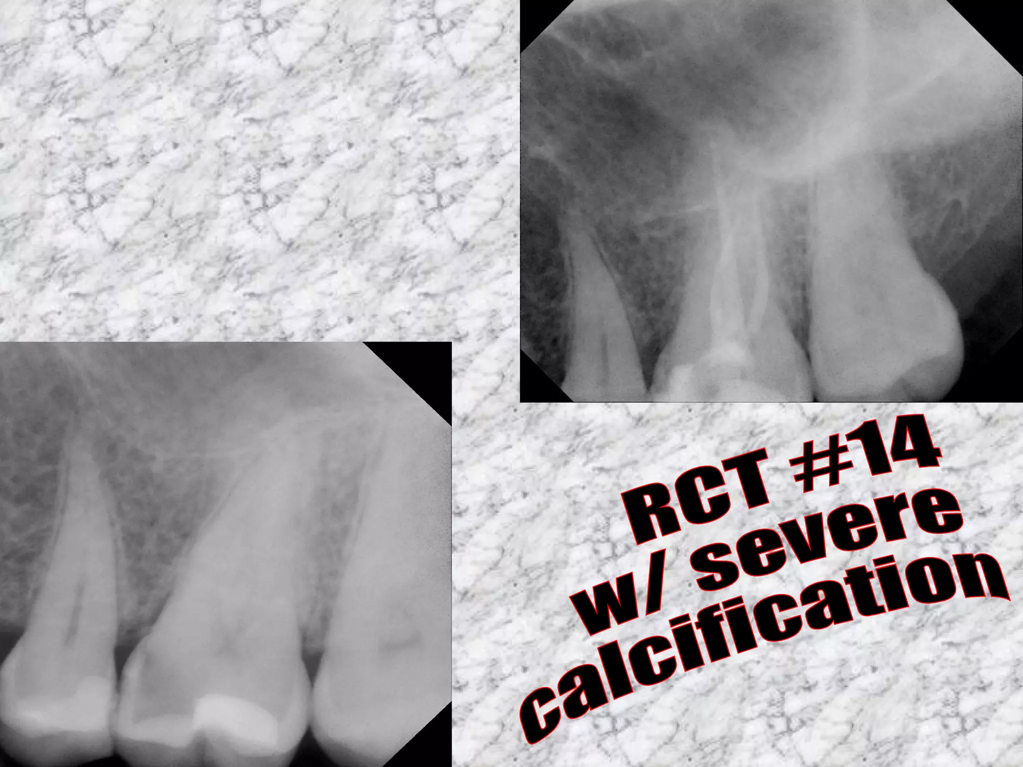 Endodontic clinical cases 2 | PPT