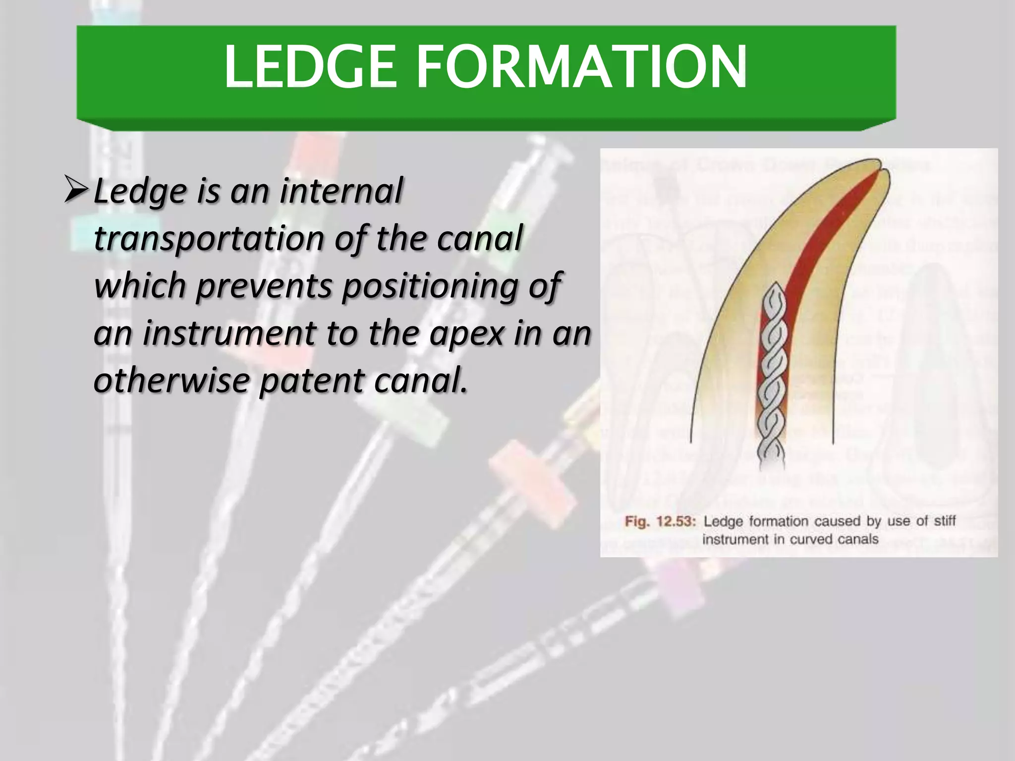 Endodontic complications | PPTX