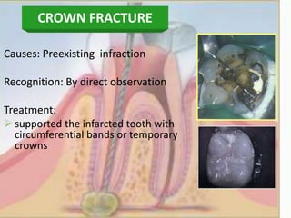 Endodontic complications | PPTX