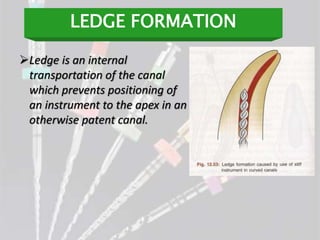 Endodontic complications | PPTX