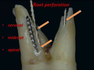 Endodontic complications | PPTX