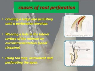 Endodontic complications | PPTX