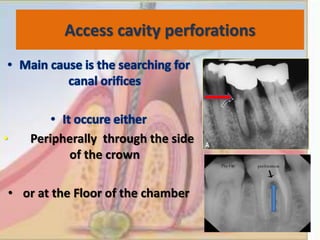 Endodontic complications | PPTX