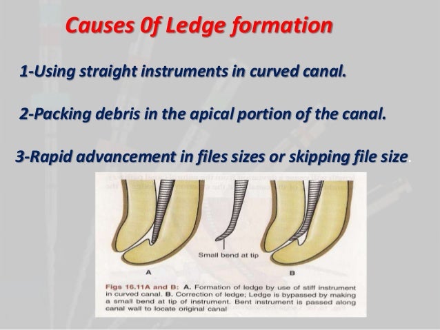 Endodontic complications