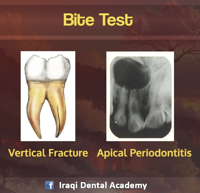 Endodontic Diagnosis: Pulp Vitality Tests | PDF | Dental Health ...