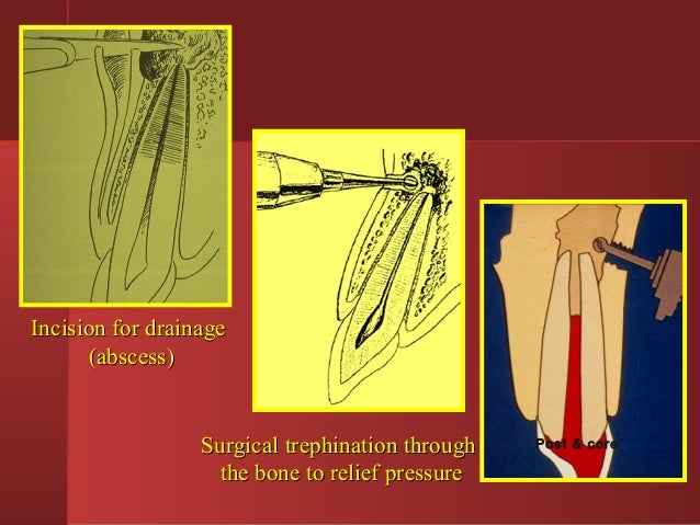Endodontic emergencies