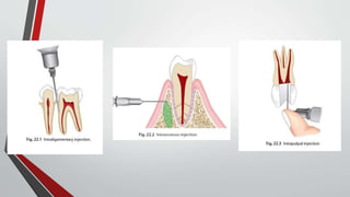 Endodontic Emergencies.pptxEndodontic Emergencies.pptx