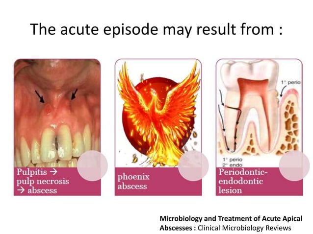 ENDODONTIC EMERGENCIES | PPTX | Dental Health | Diseases and Conditions