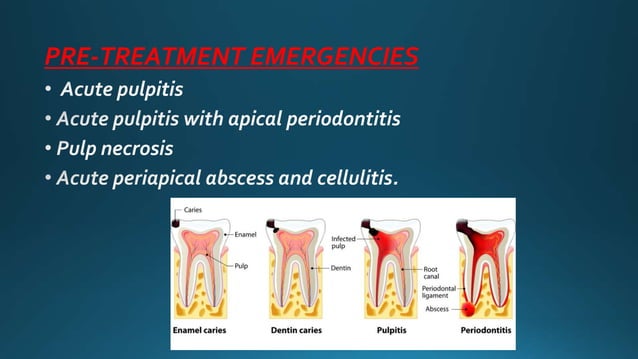 Endodontic emergency | PPTX