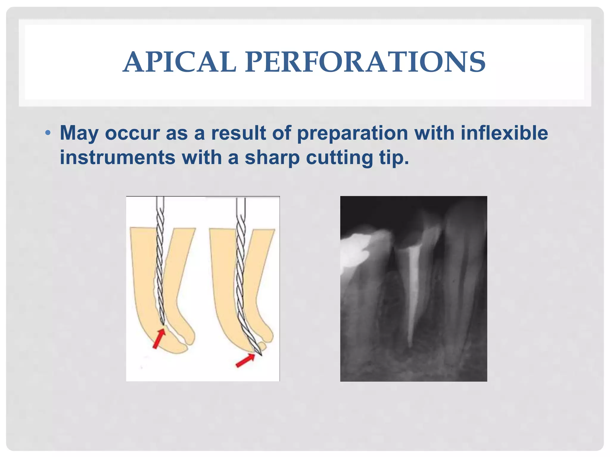 Endodontic Errors | PPTX