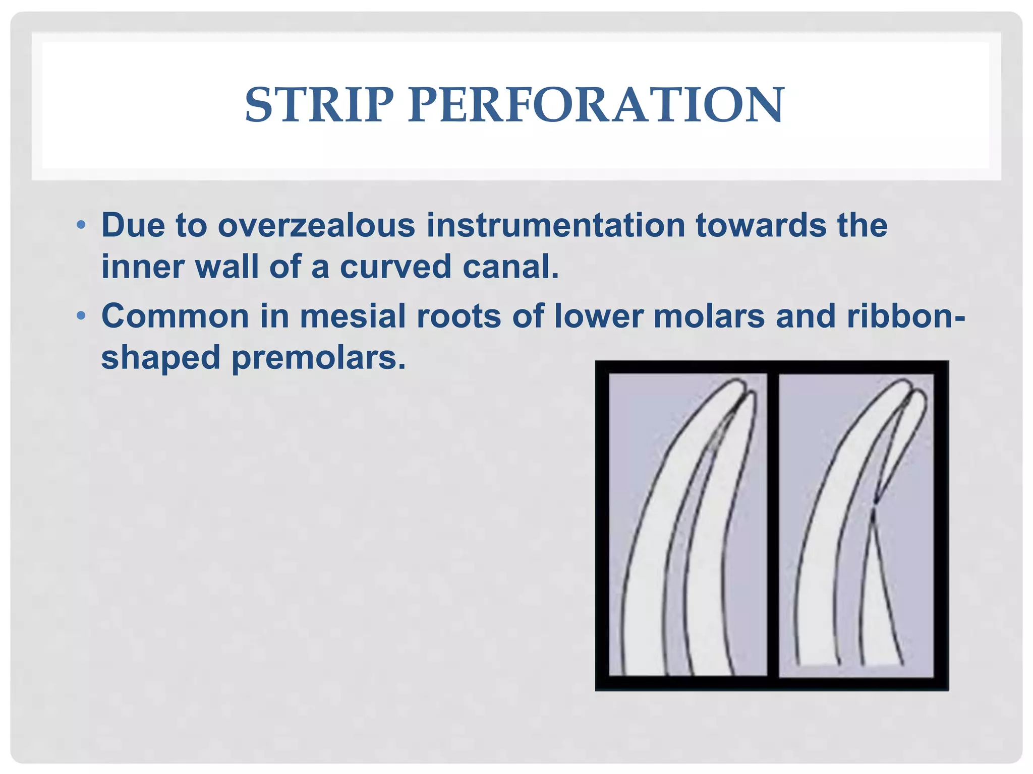 Endodontic Errors | PPTX