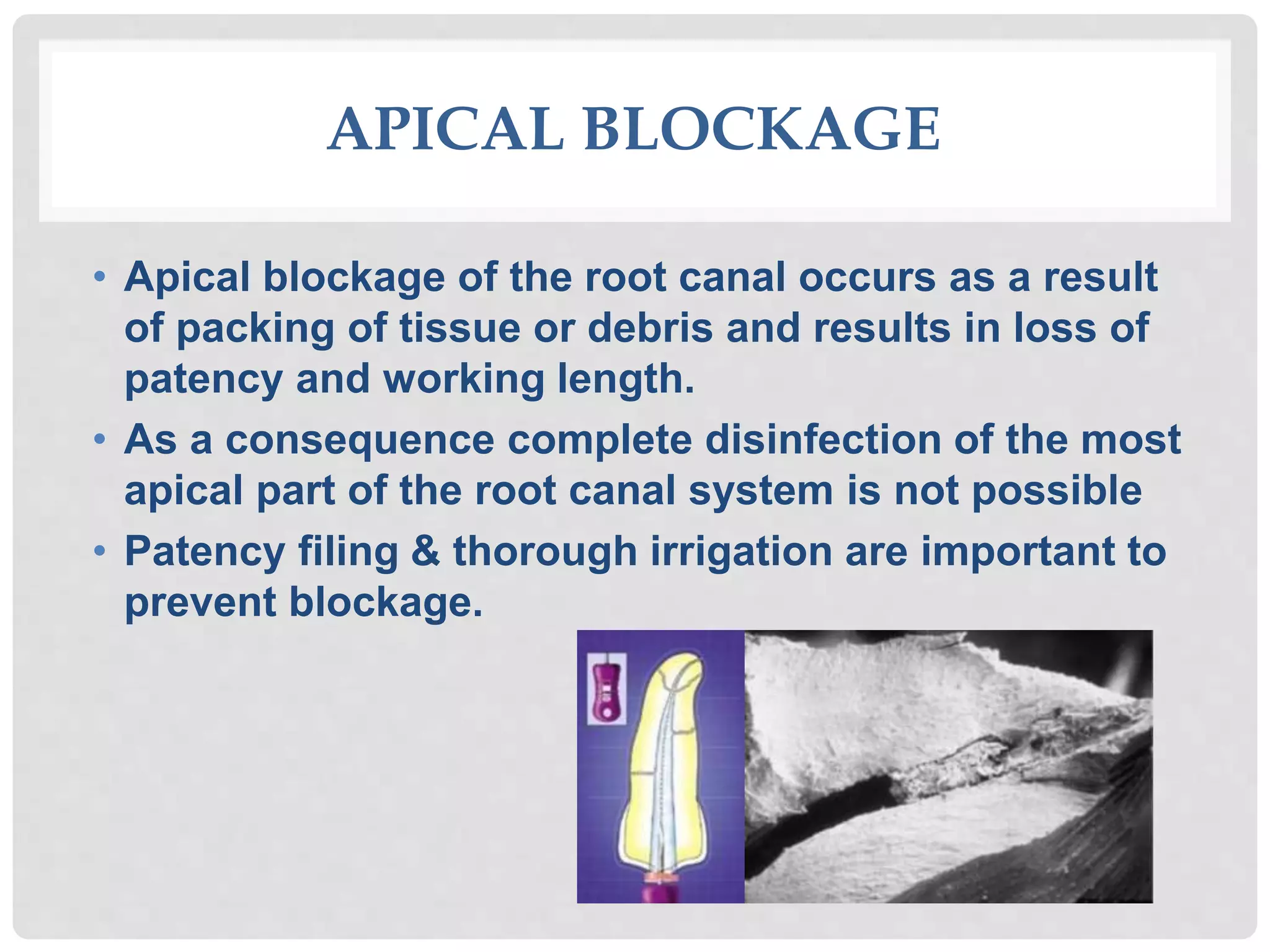 Endodontic Errors | PPTX