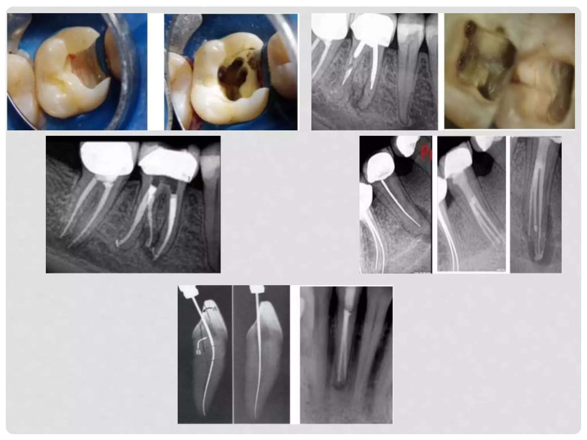 Endodontic Errors | PPTX