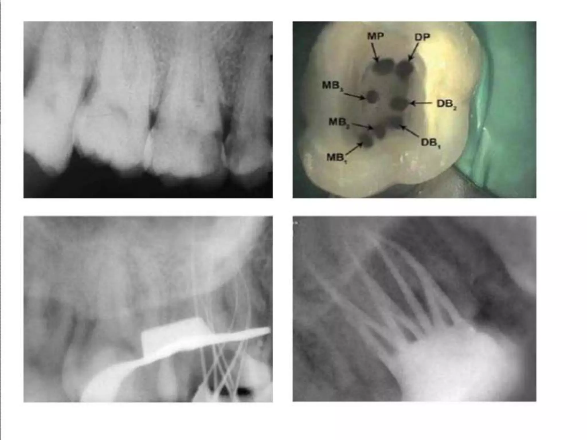 Endodontic Errors | PPTX