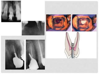 Endodontic Errors | PPTX