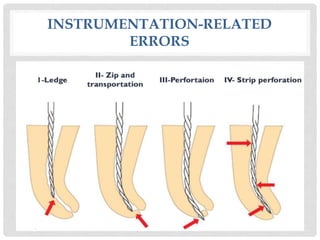 Endodontic Errors | PPTX