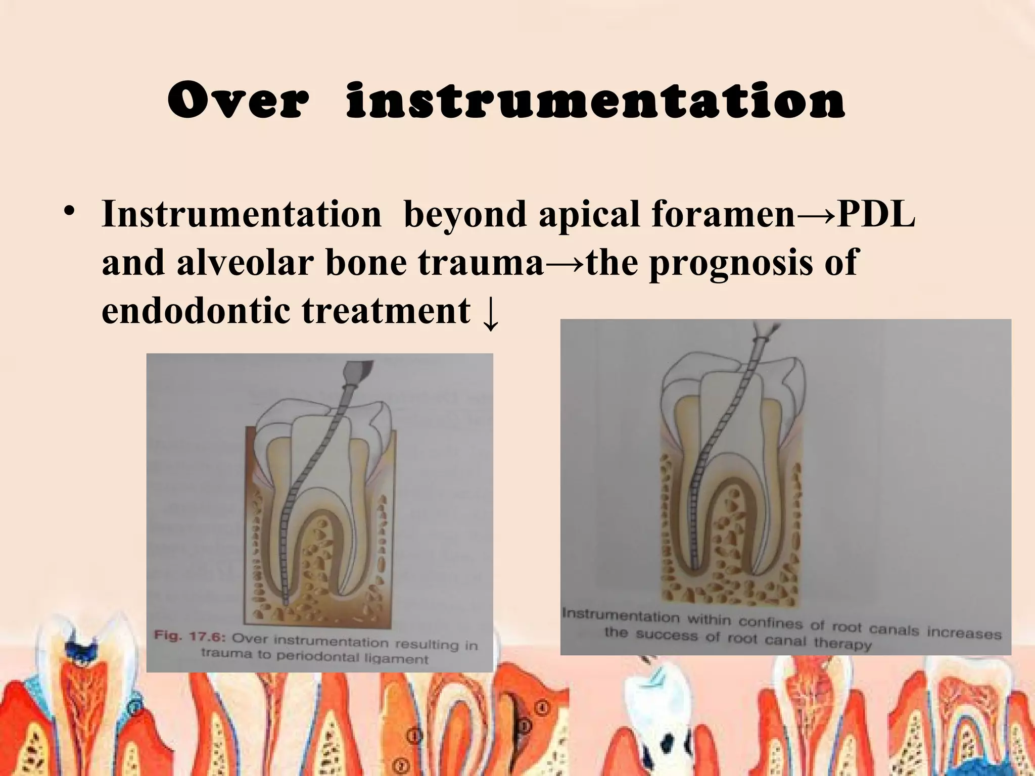Endodontic failures | PPT
