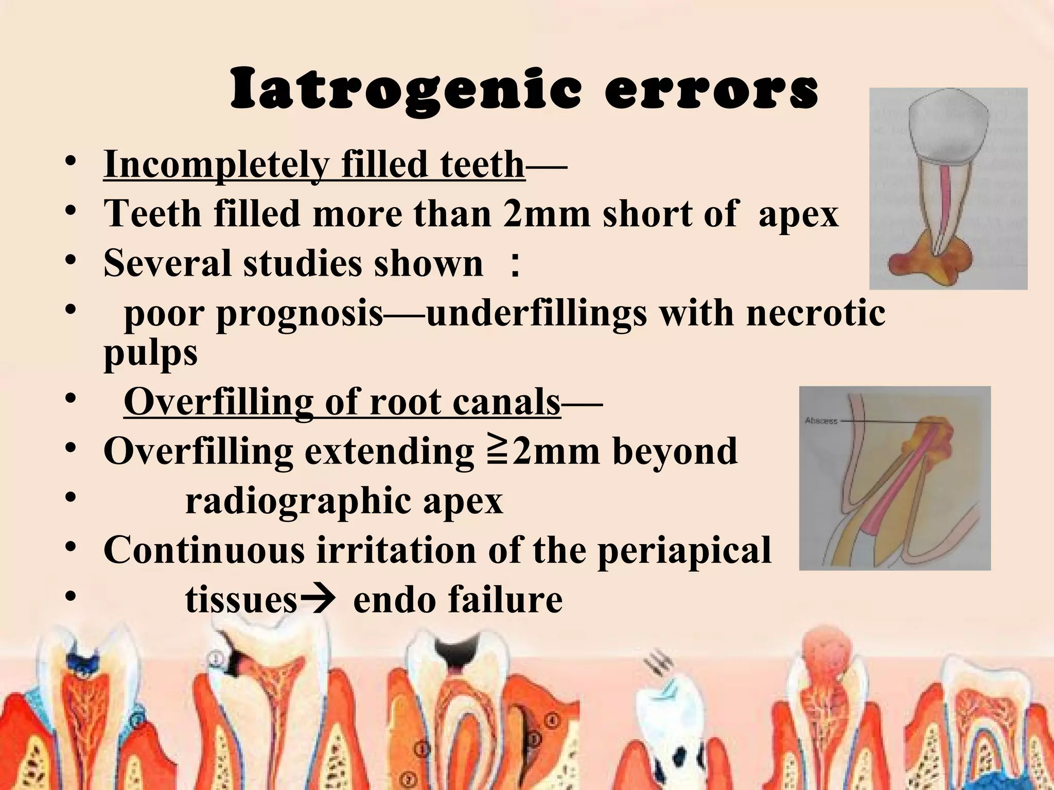 Endodontic failures | PPT