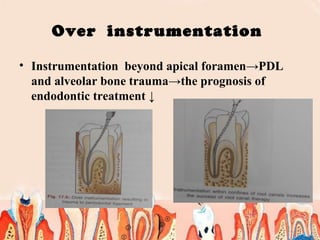 Endodontic failures | PPT