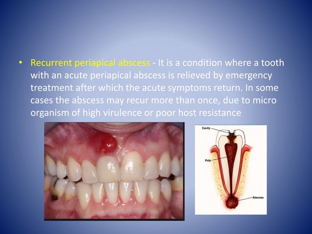 Endodontic flareup | PPT | Free Download
