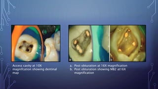 Endodontic gadgets | PPTX