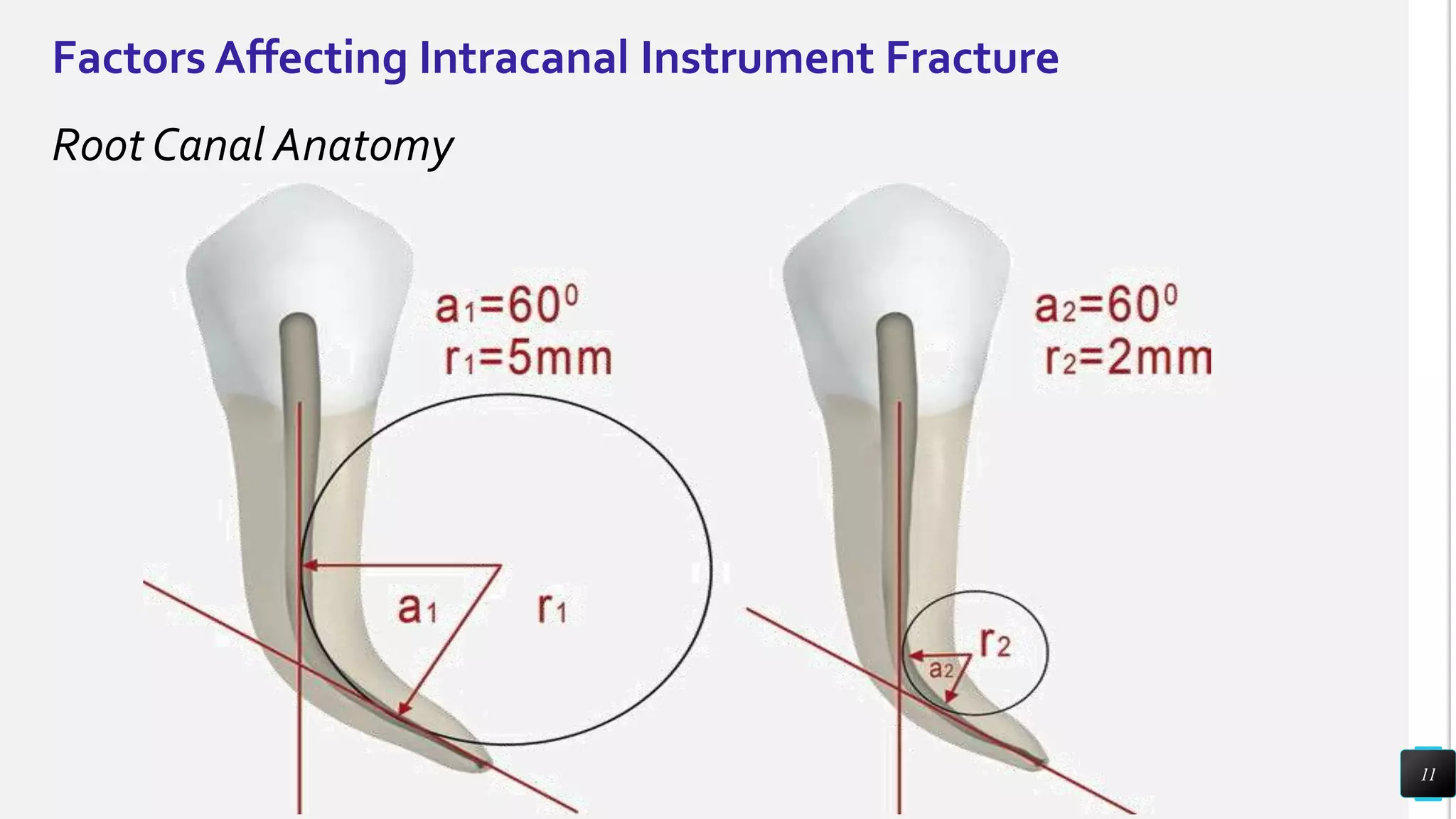 Endodontic instrument fracture and thier management by dr.maryam salman ...