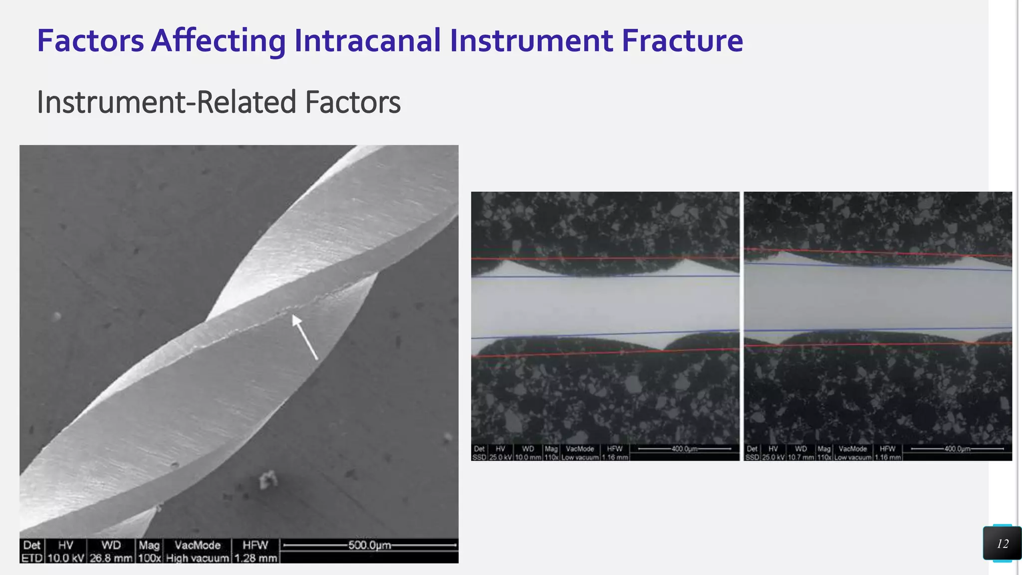 Endodontic instrument fracture and thier management by dr.maryam salman ...