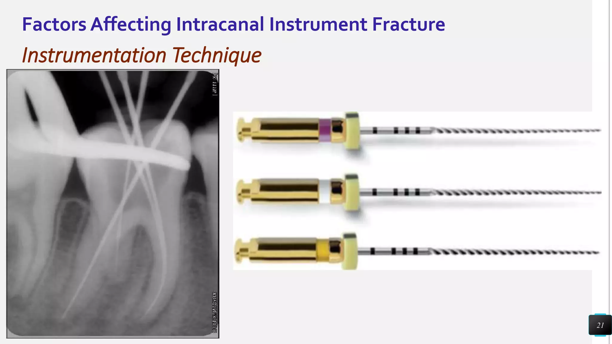 Endodontic instrument fracture and thier management by dr.maryam salman ...