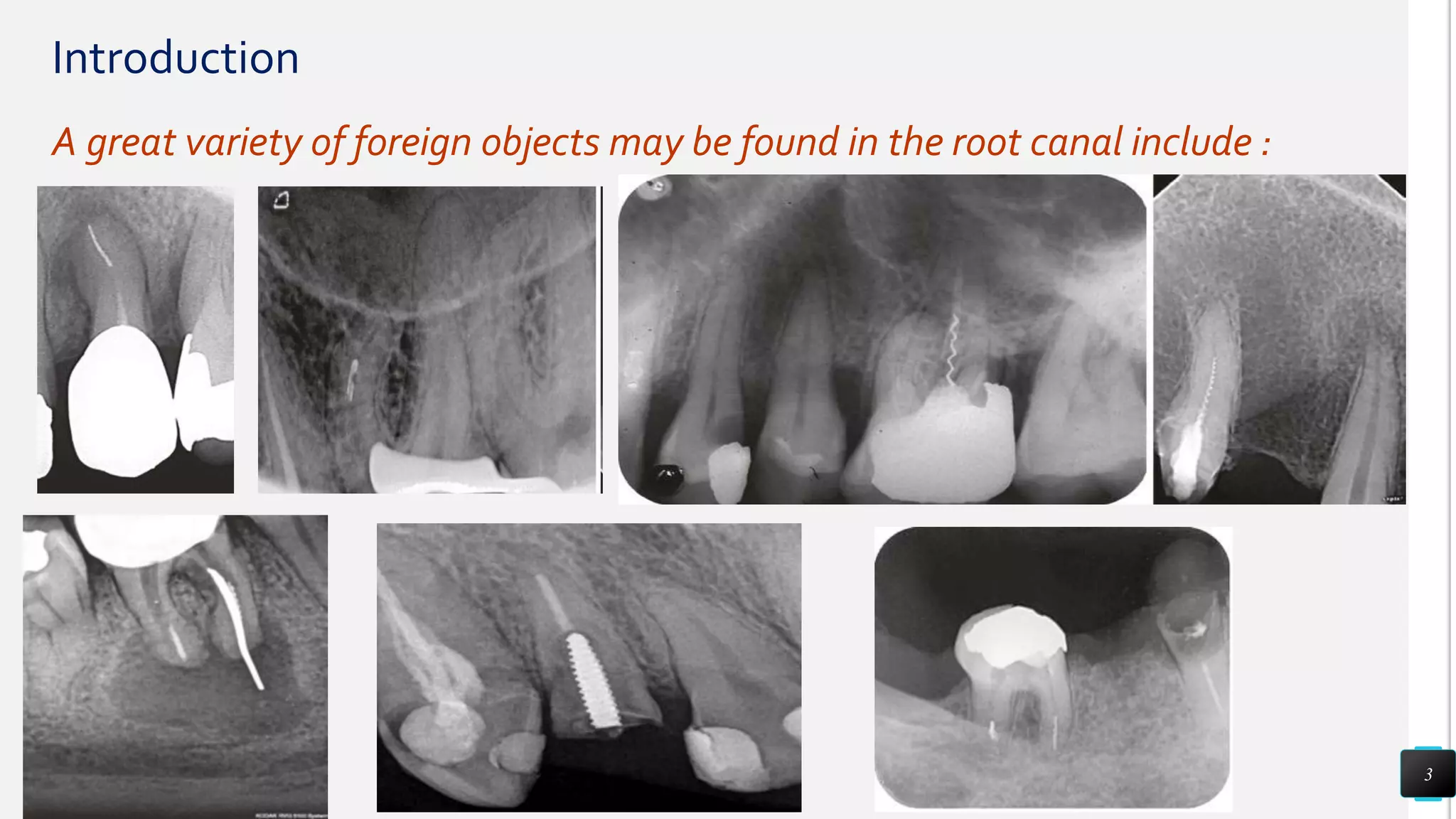 Endodontic instrument fracture and thier management by dr.maryam salman ...