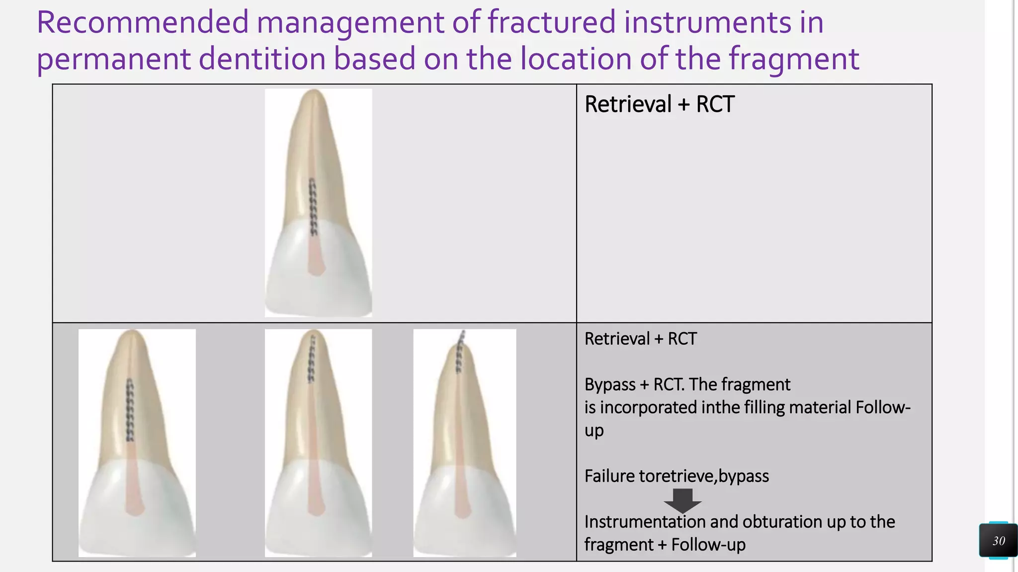 Endodontic instrument fracture and thier management by dr.maryam salman ...