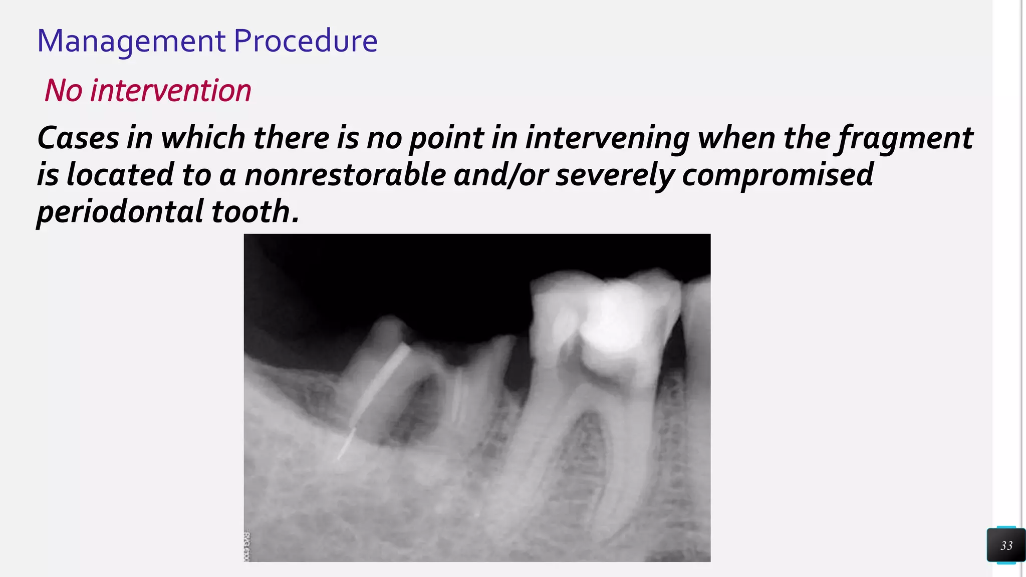 Endodontic instrument fracture and thier management by dr.maryam salman ...