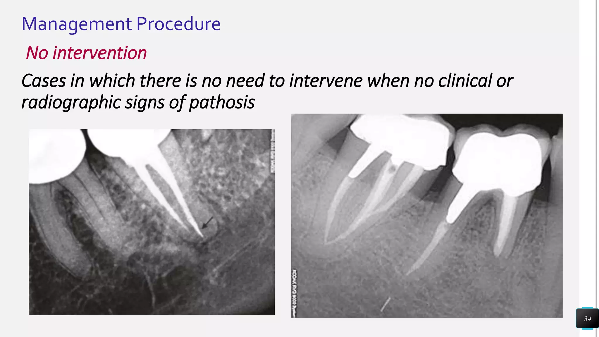 Endodontic instrument fracture and thier management by dr.maryam salman ...