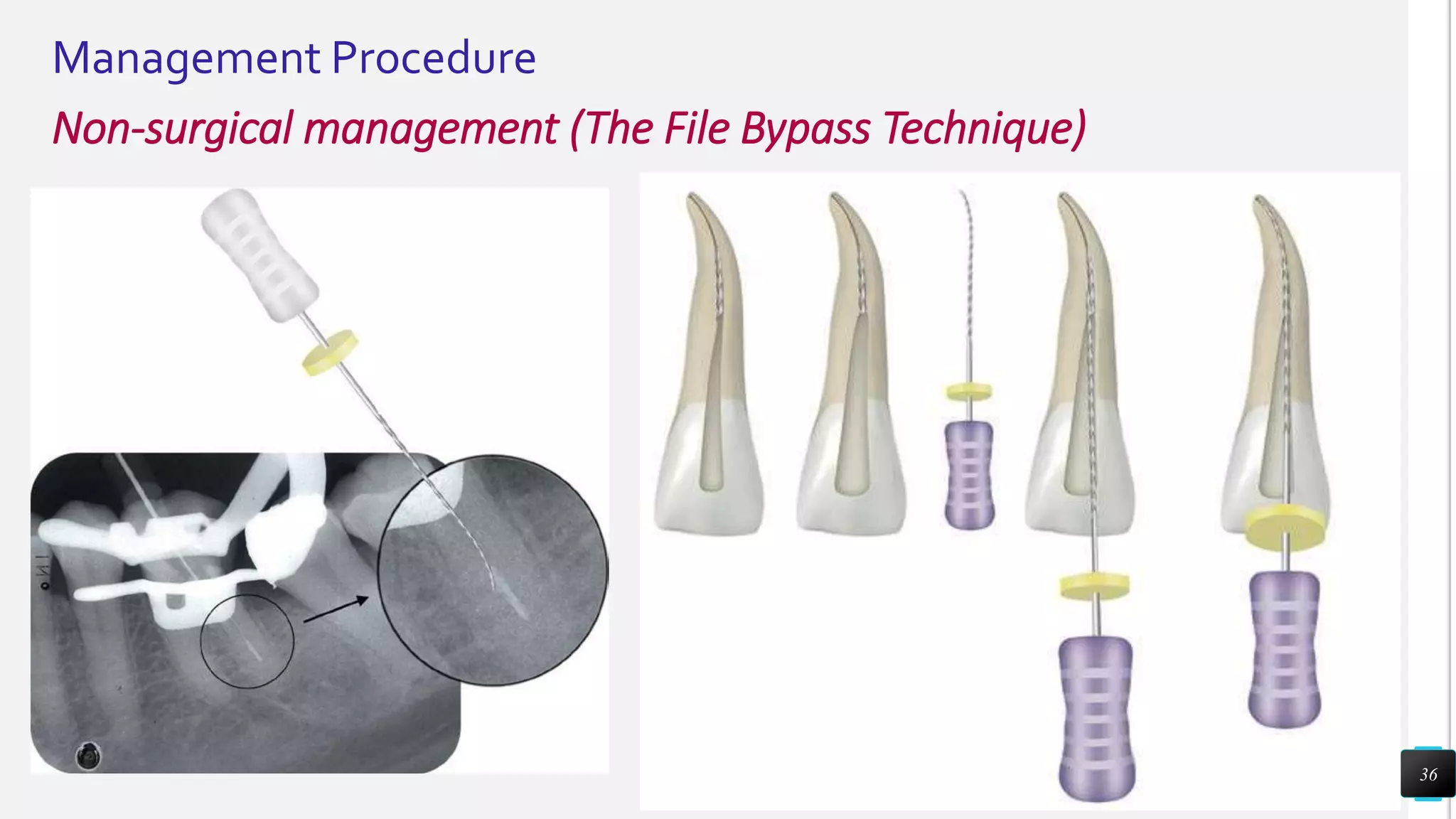 Endodontic instrument fracture and thier management by dr.maryam salman ...