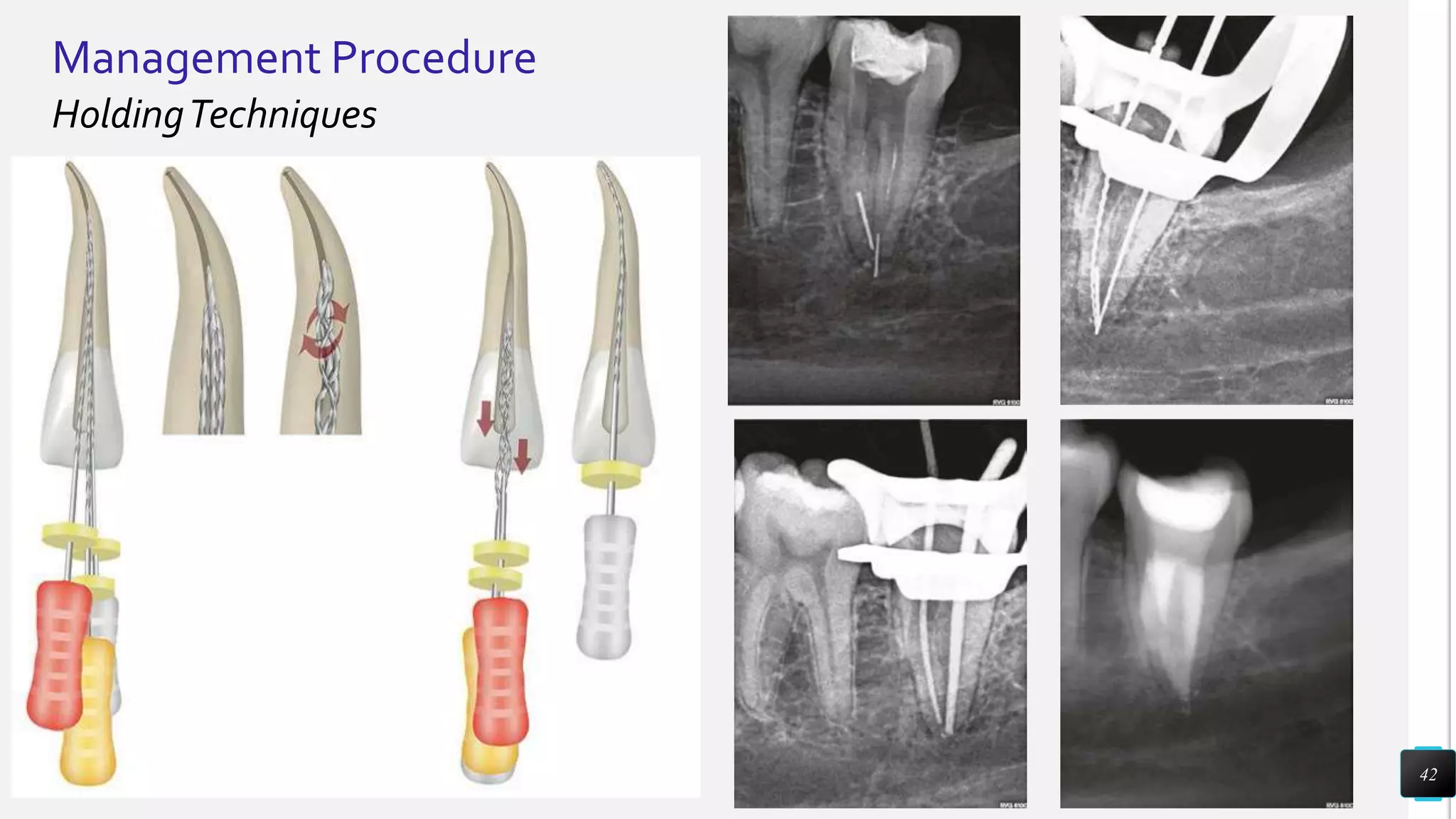 Endodontic instrument fracture and thier management by dr.maryam salman ...