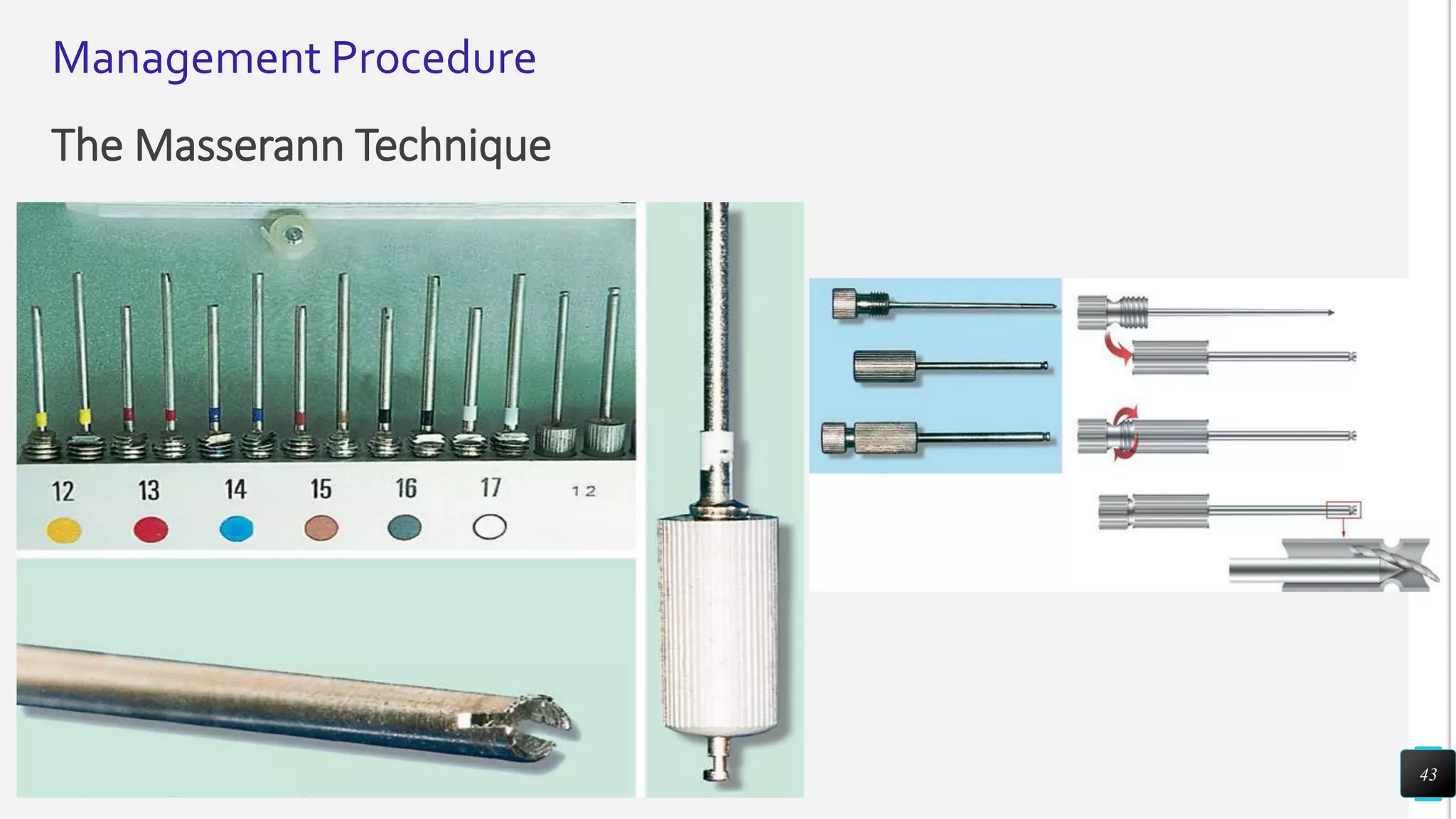 Endodontic instrument fracture and thier management by dr.maryam salman ...