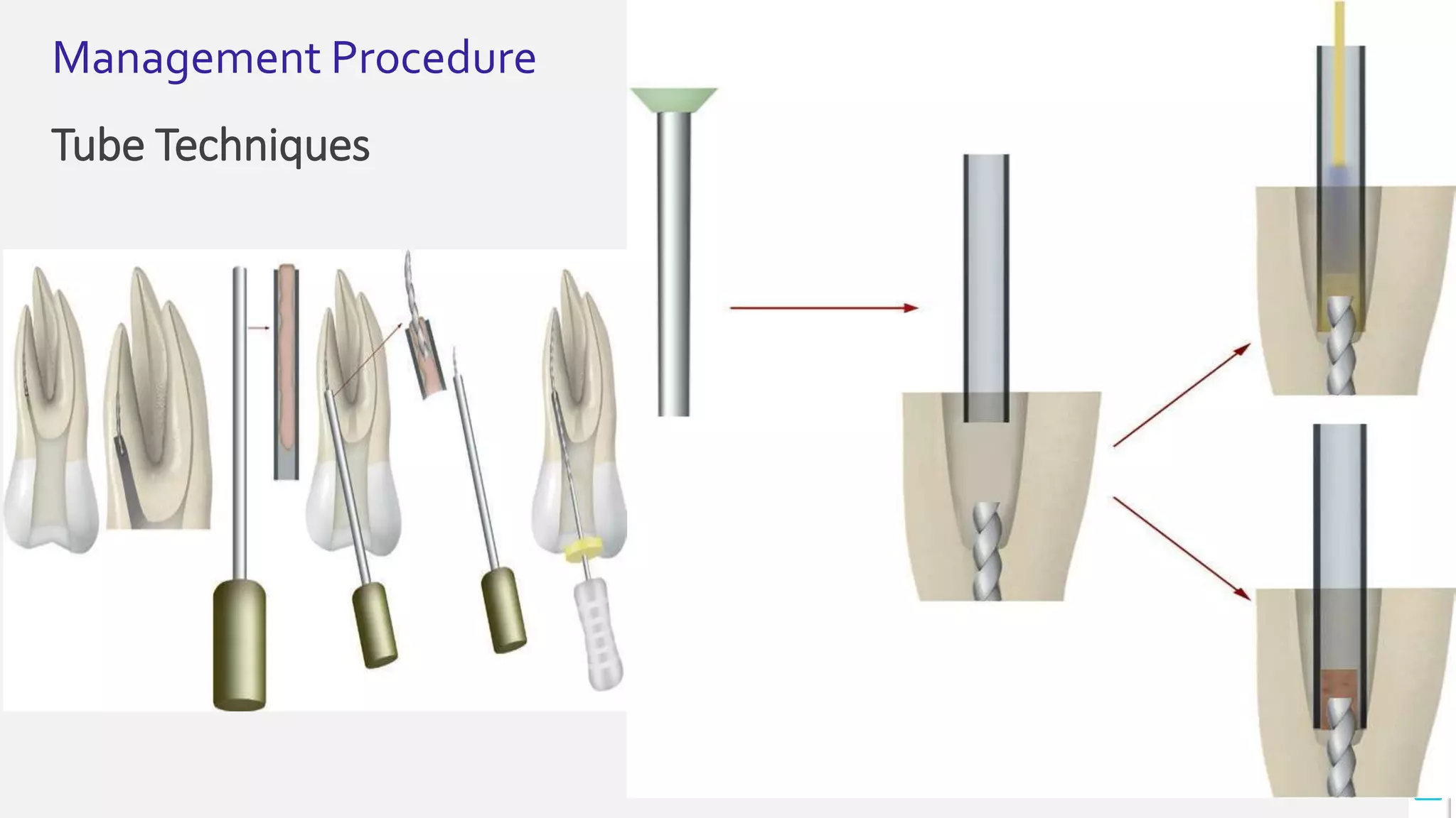 Endodontic instrument fracture and thier management by dr.maryam salman ...