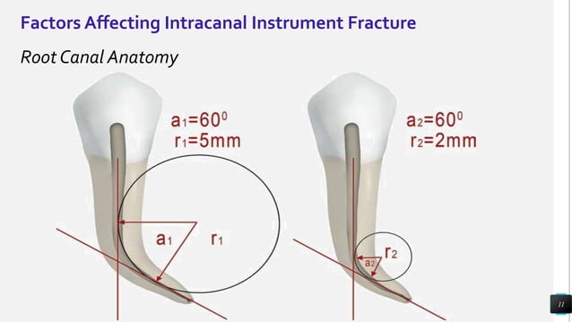 Endodontic instrument fracture and thier management by dr.maryam salman ...