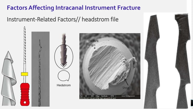 Endodontic instrument fracture and thier management by dr.maryam salman ...