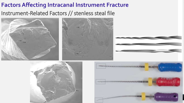 Endodontic instrument fracture and thier management by dr.maryam salman ...