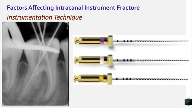 Endodontic instrument fracture and thier management by dr.maryam salman ...