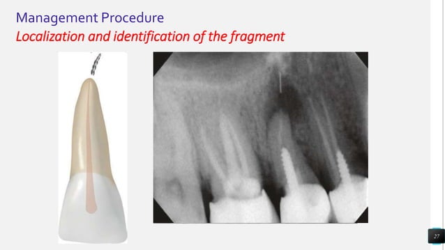 Endodontic instrument fracture and thier management by dr.maryam salman ...