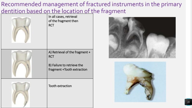 Endodontic instrument fracture and thier management by dr.maryam salman ...
