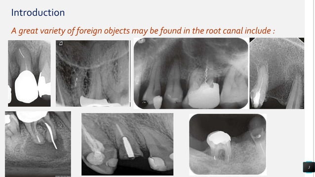 Endodontic instrument fracture and thier management by dr.maryam salman ...