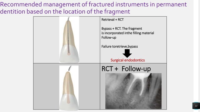 Endodontic instrument fracture and thier management by dr.maryam salman ...