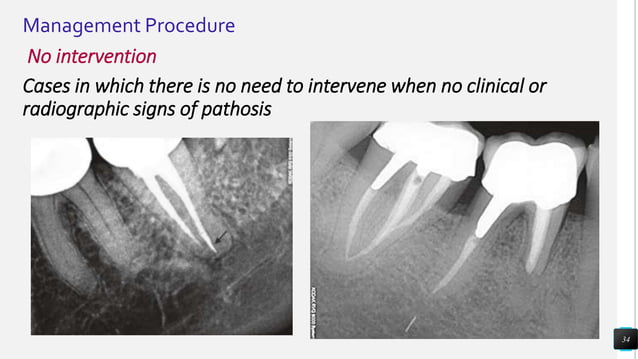 Endodontic instrument fracture and thier management by dr.maryam salman ...