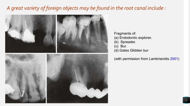 Endodontic instrument fracture and thier management by dr.maryam salman ...