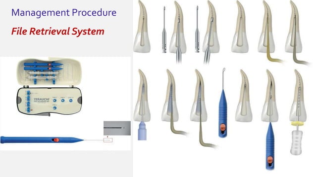 Endodontic instrument fracture and thier management by dr.maryam salman ...