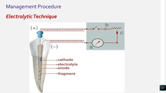 Endodontic instrument fracture and thier management by dr.maryam salman ...