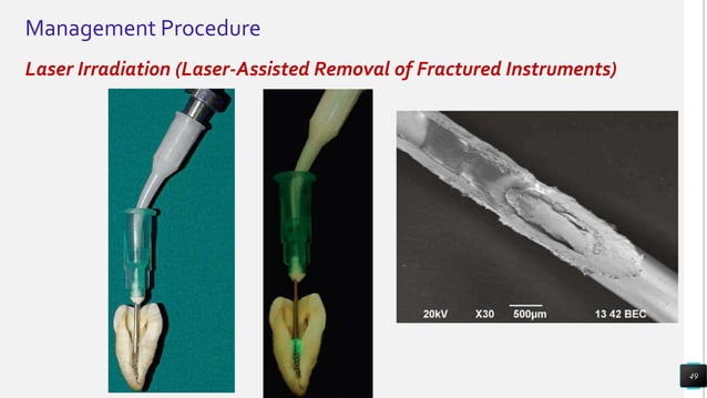 Endodontic instrument fracture and thier management by dr.maryam salman ...